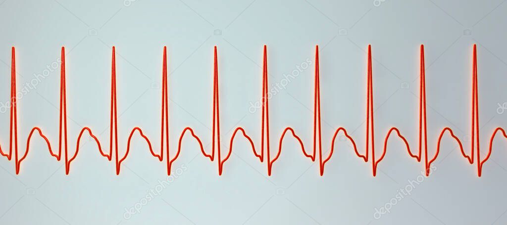 ECG en taquicardia supraventricular, una frecuencia cardíaca rápida que se origina por encima de ...