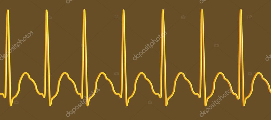 ECG en taquicardia supraventricular, una frecuencia cardíaca rápida que se origina por encima de ...