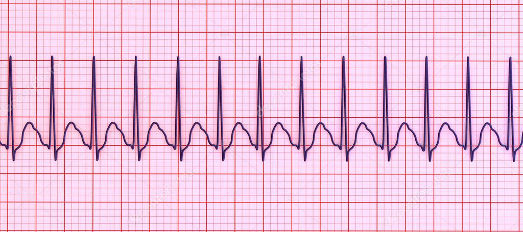 ECG en taquicardia supraventricular, una frecuencia cardíaca rápida que ...
