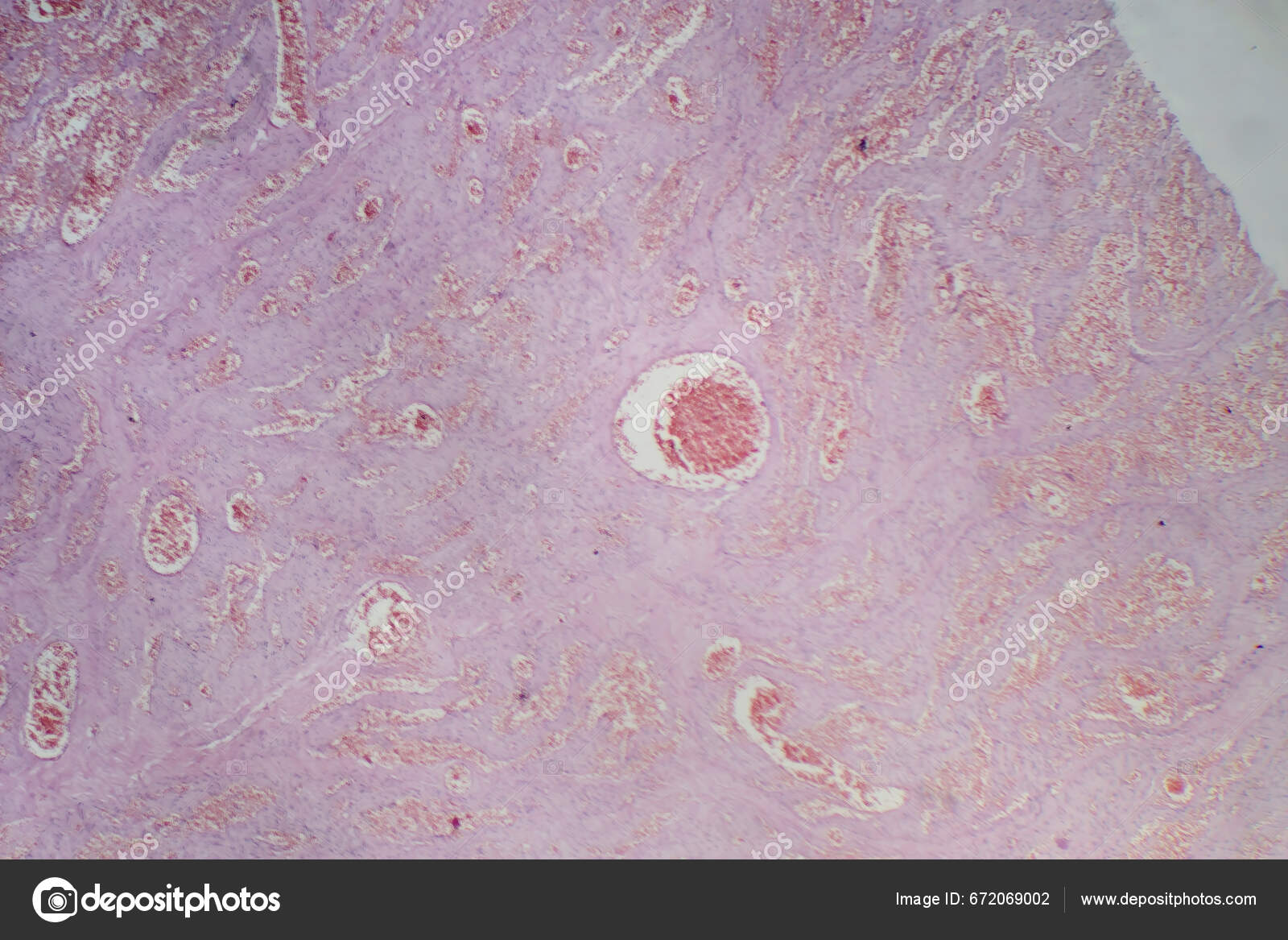 Photomicrograph Capillary Hemangioma Illustrating Abnormal ...