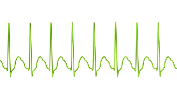 ECG en aleteo auricular, un ritmo cardíaco anormal caracterizado por ...