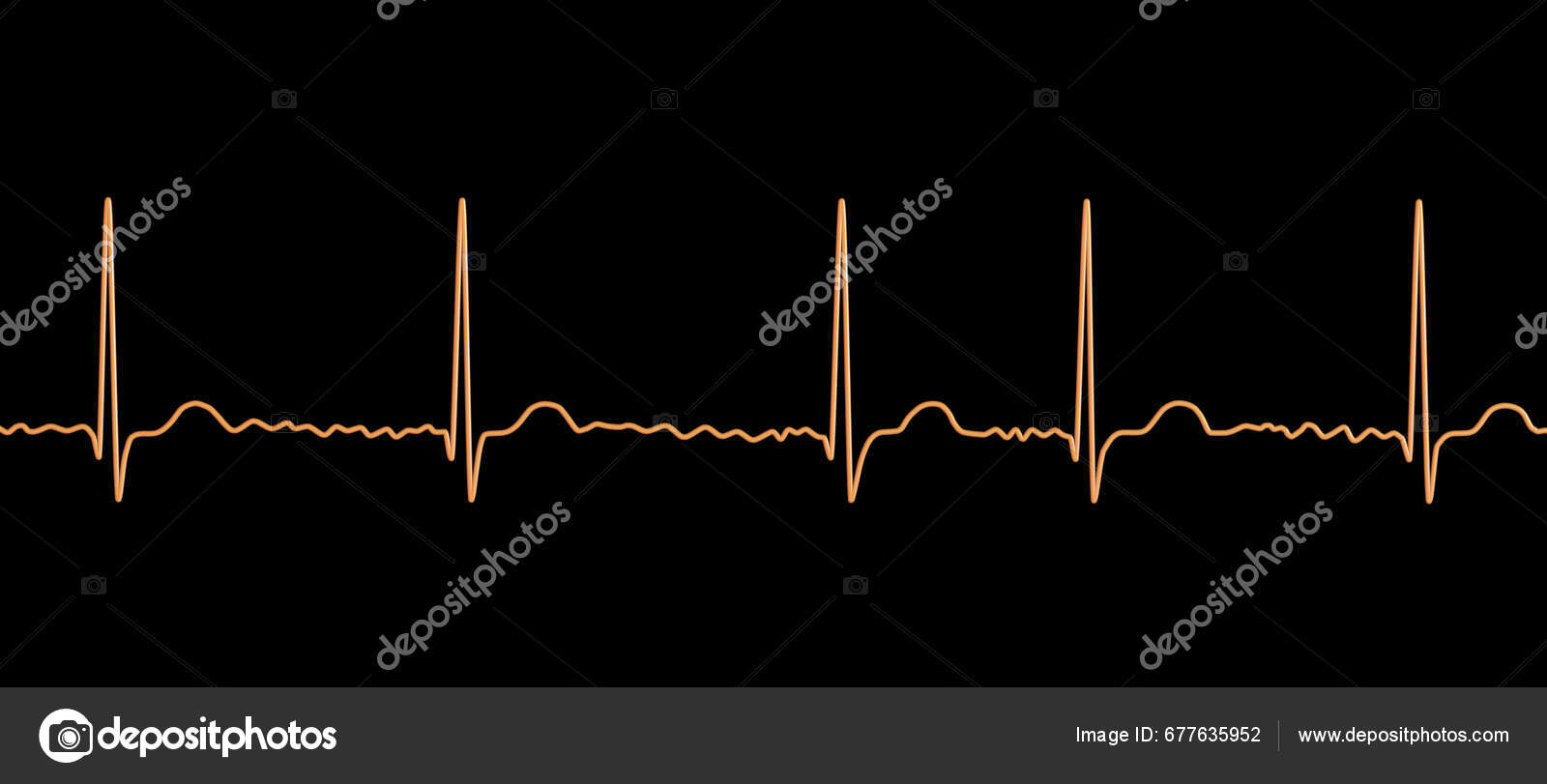 Ecg Atrial Fibrillation Afib Illustration Depicts Irregular Rhythm ...