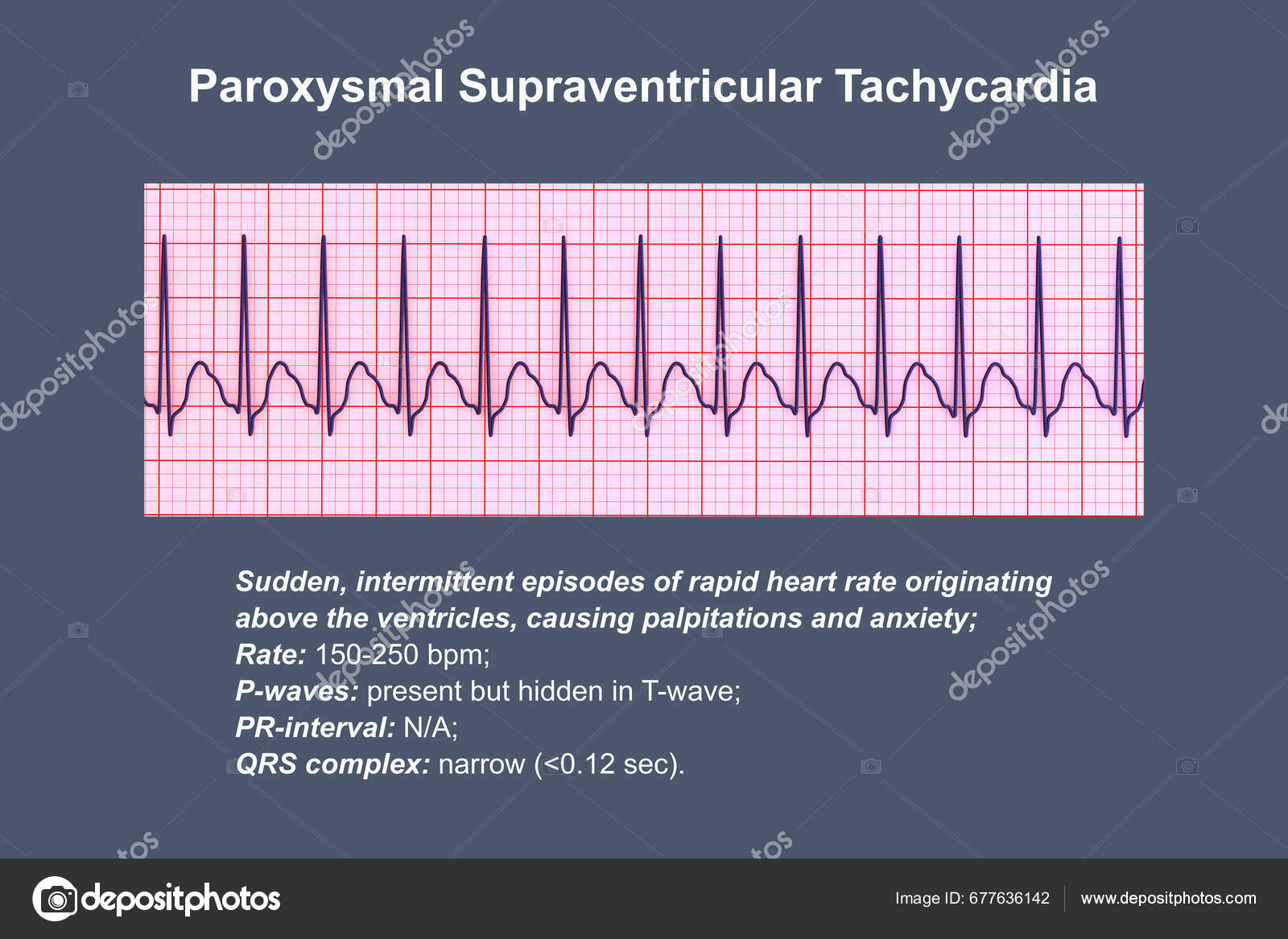 Ecg Taquicardia Supraventricular Uma Frequência Cardíaca Rápida Que ...