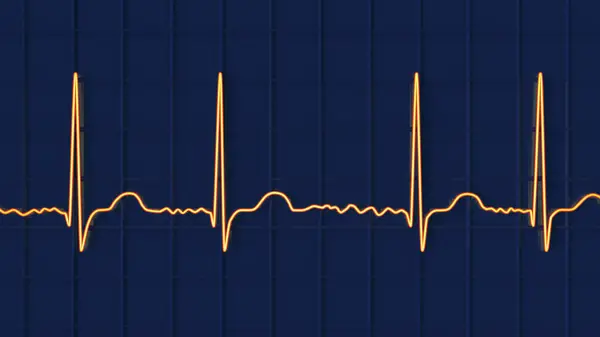 Ecg Atrial Fibrillation Afib Illustration Depicts Irregular Rhythm ...