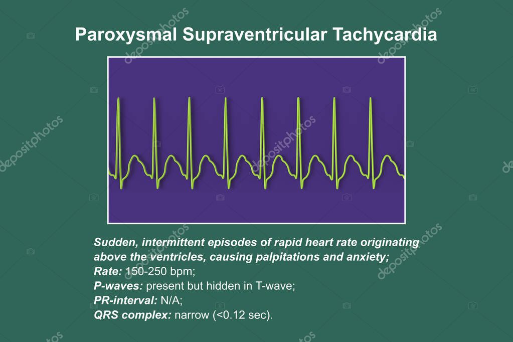 ECG en taquicardia supraventricular, una frecuencia cardíaca rápida que se origina por encima de ...