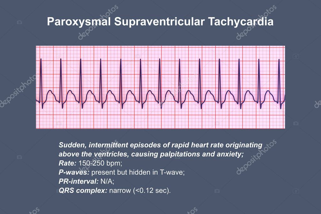 ECG en taquicardia supraventricular, una frecuencia cardíaca rápida que se origina por encima de ...