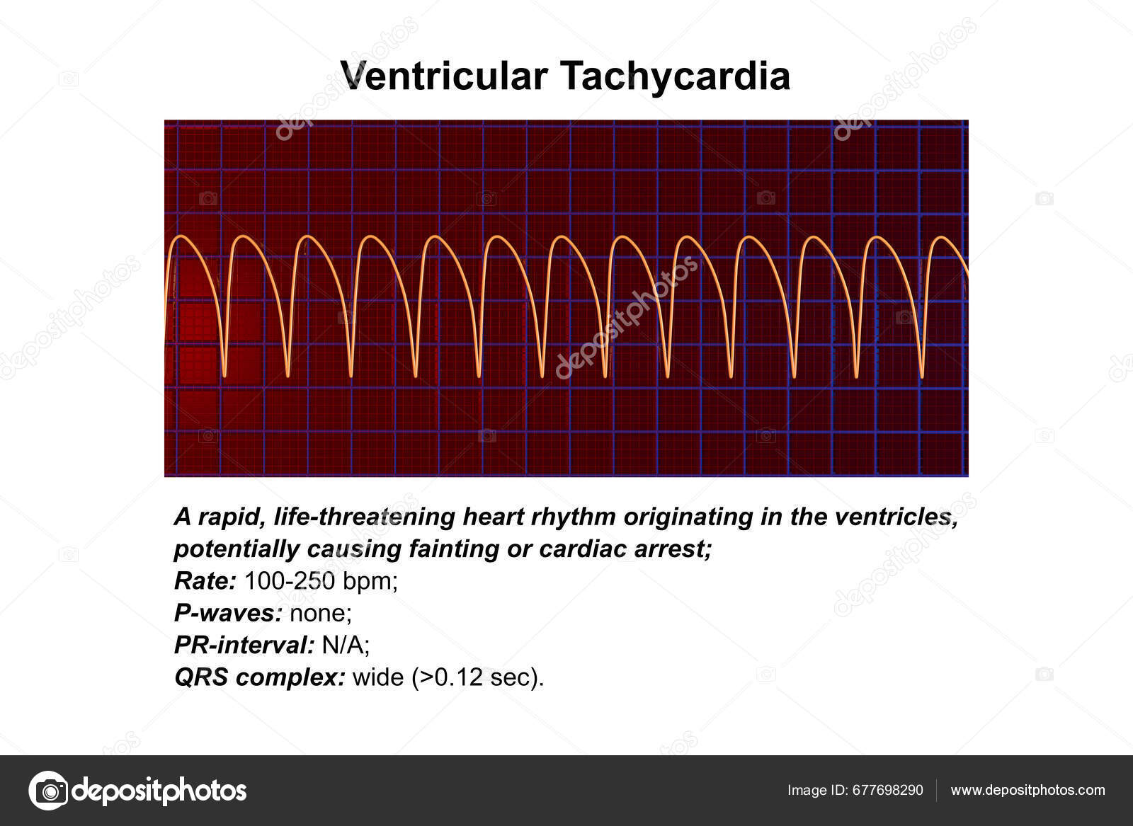 Ventricular Tachycardia Rapid Heart Rhythm Originating Ventricles ...