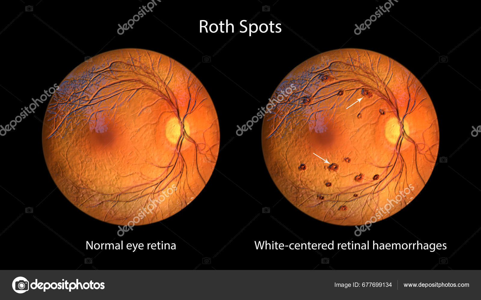 Roth Spots Retina Seen Ophthalmoscopy Illustration Showing White ...