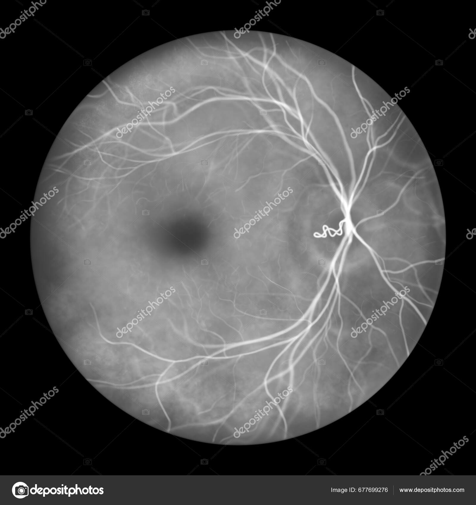 Prepapillary Vascular Loop Retina Observed Ophthalmoscopy Fluorescein ...