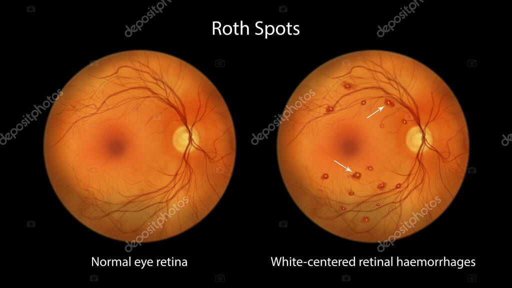 Manchas de Roth en la retina como se ve durante la oftalmoscopia, una ...