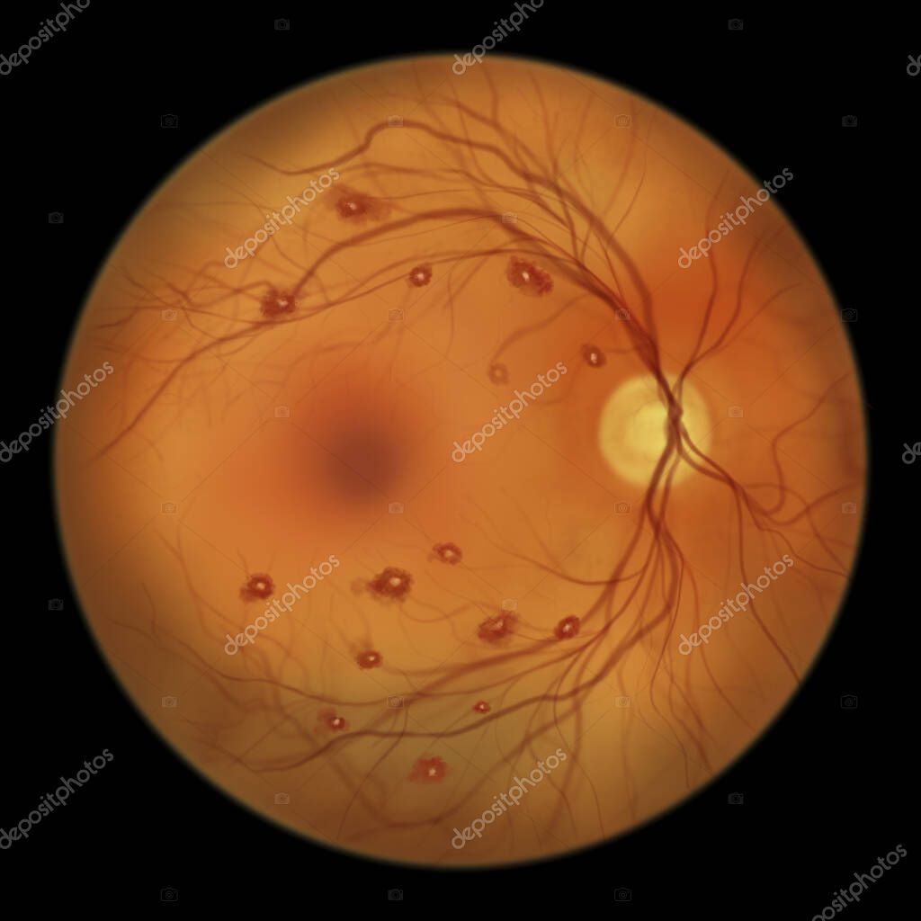 Manchas de Roth en la retina como se observó durante la oftalmoscopia ...