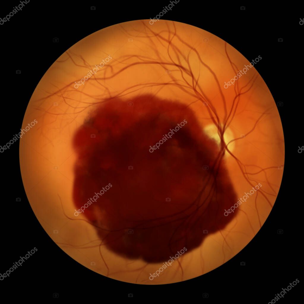 Ilustración médica de una hemorragia subretiniana observada durante la ...