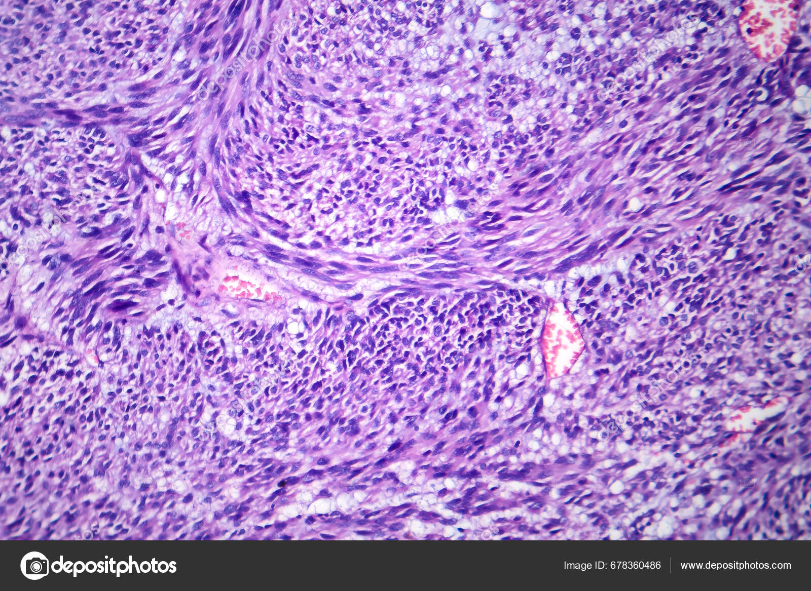 Photomicrograph Leiomyoma Illustrating Benign Smooth Muscle Tumor Cells