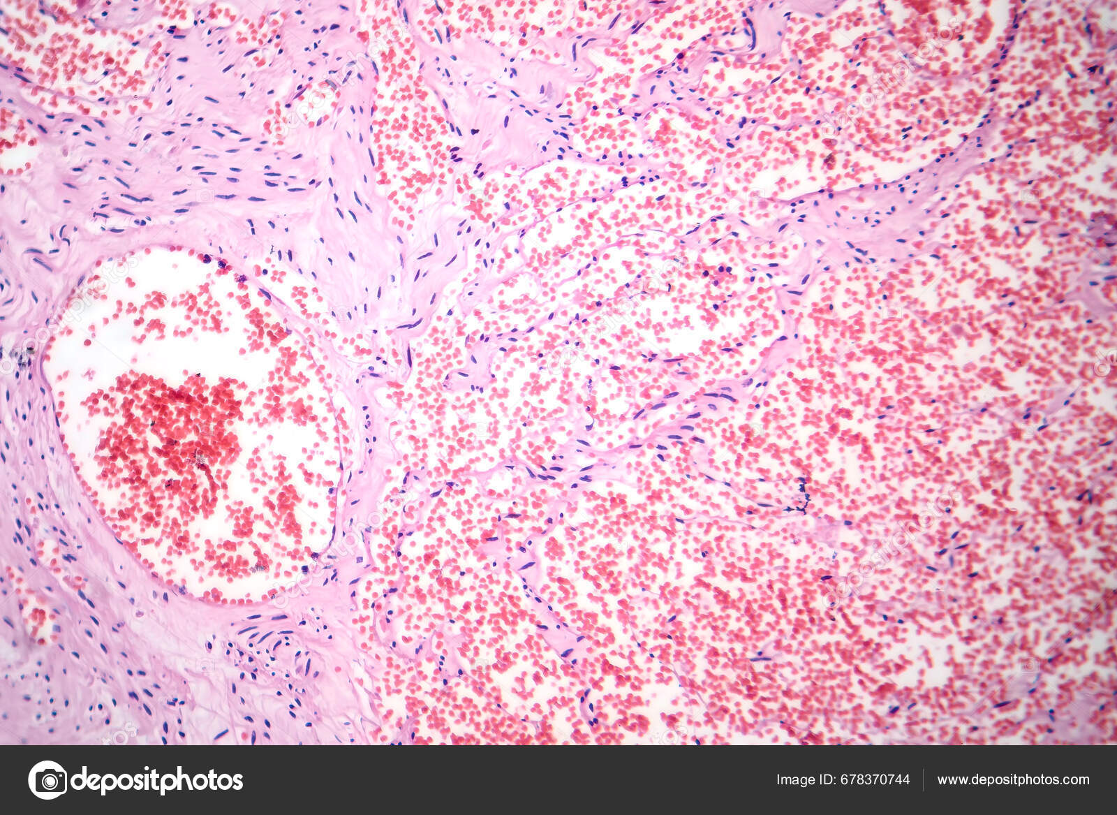 Photomicrograph Capillary Hemangioma Illustrating Abnormal ...