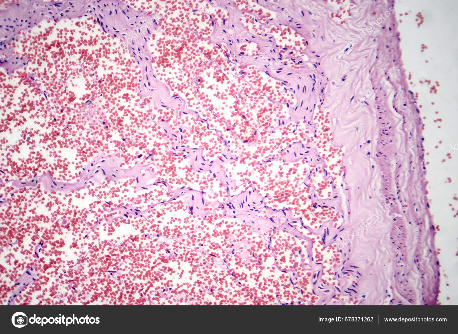 Photomicrograph Capillary Hemangioma Illustrating Abnormal ...