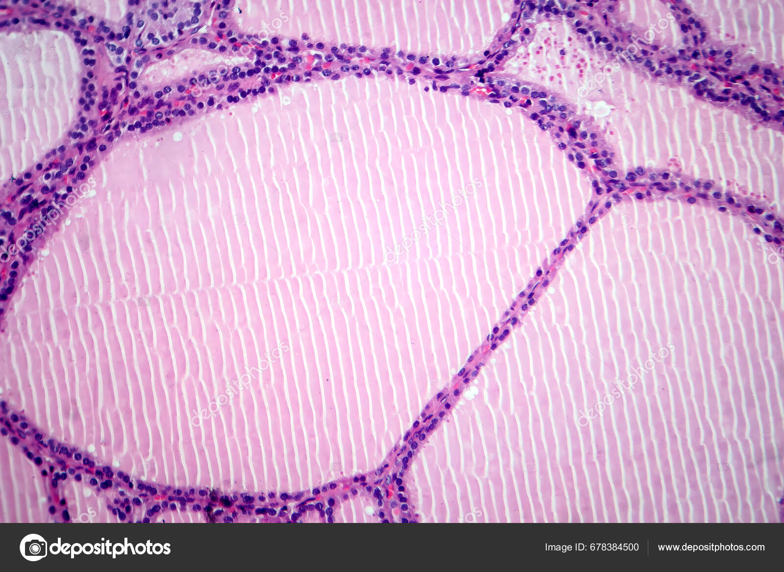 Photomicrograph Endemic Goiter Tissue Sample Microscope Revealing ...
