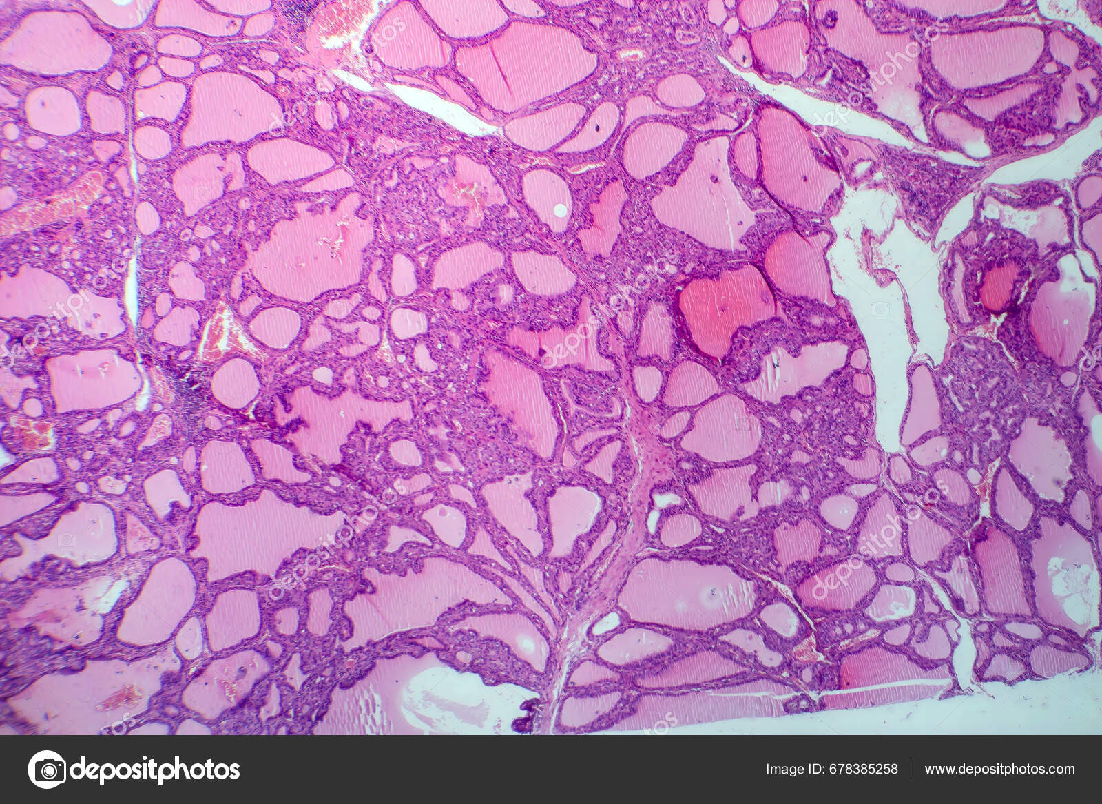 Photomicrograph Toxic Goiter Tissue Sample Microscope Revealing ...