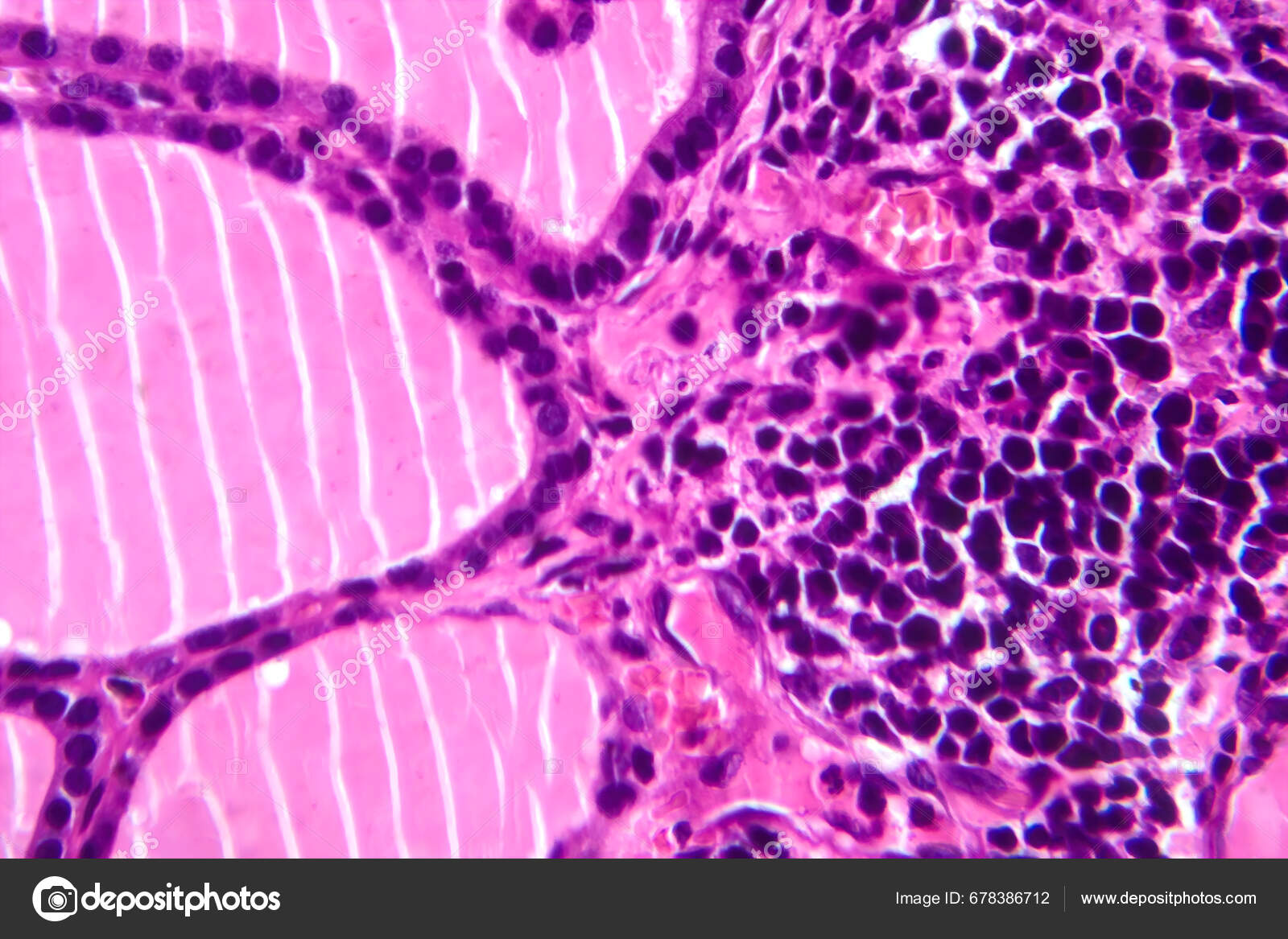 Photomicrograph Toxic Goiter Tissue Sample Microscope Revealing ...