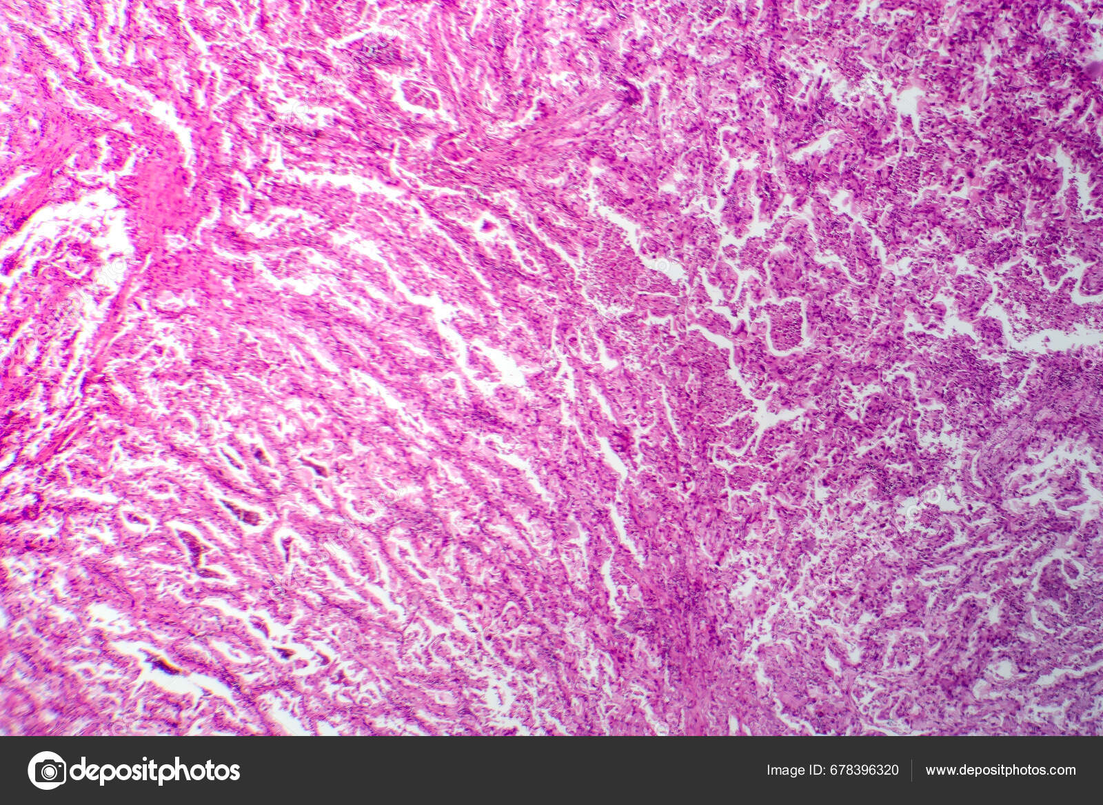 Photomicrograph Lung Cancer Tissue Revealing Malignant Cells Abnormal ...