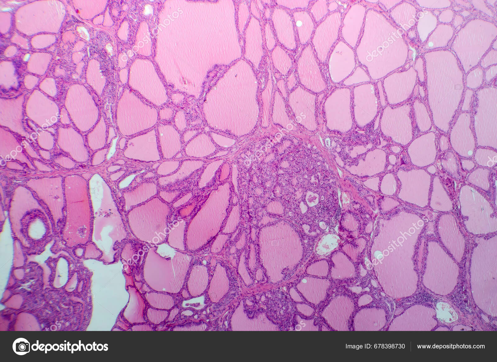 Photomicrograph Toxic Goiter Tissue Sample Microscope Revealing ...