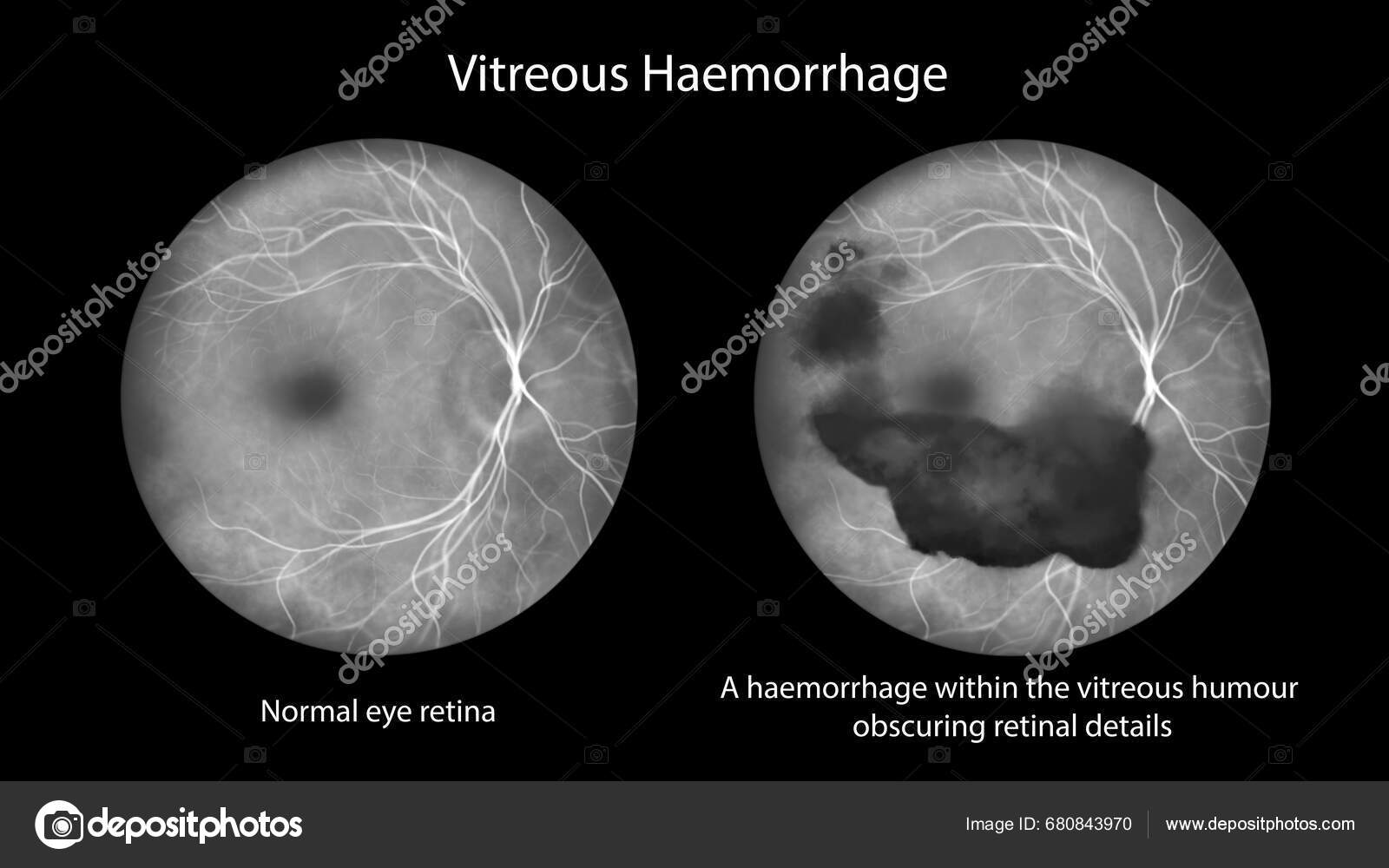 Una Ilustración Médica Que Representa Hemorragia Vítrea Observada ...