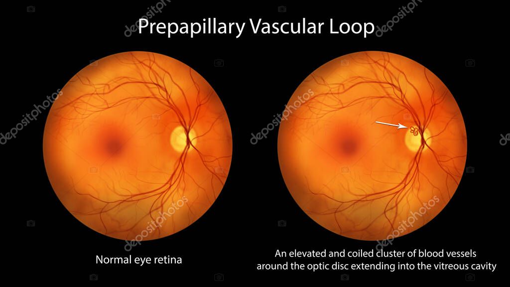 Un bucle vascular prepapilar en la retina, como se observó durante la ...