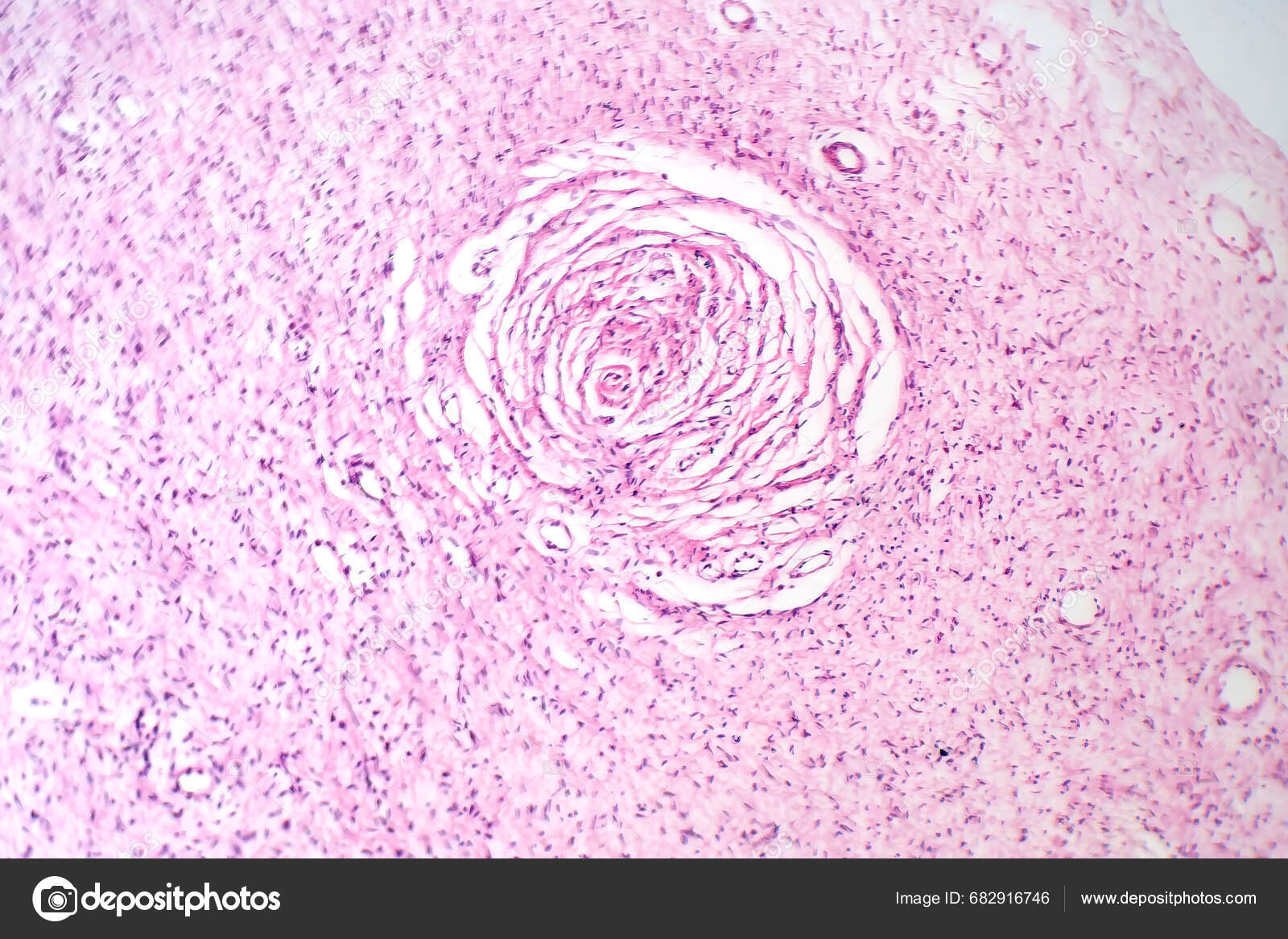 Photomicrograph Neurofibroma Tissue Sample Neurofibromatosis Genetic ...