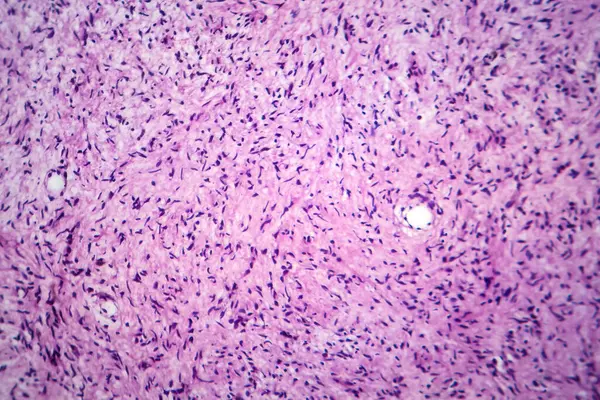 Fotomicrografía de una muestra de tejido neurofibroma en ...