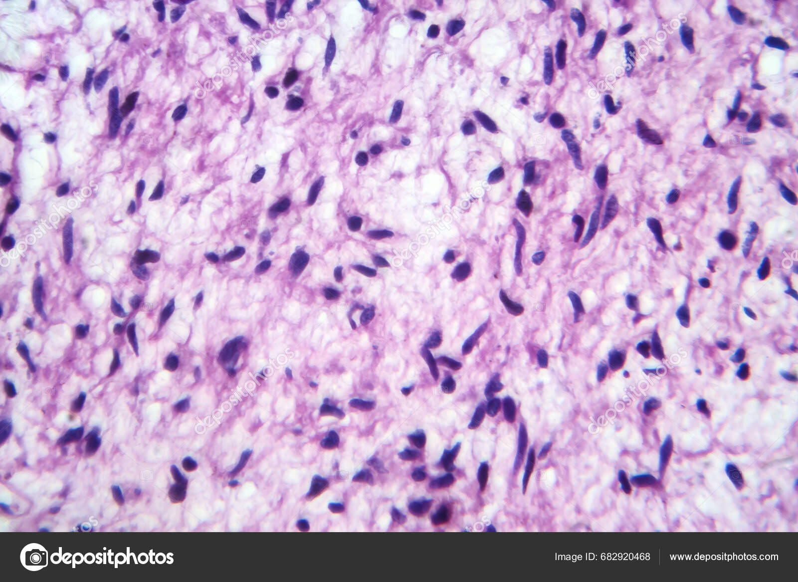 Fotografische Aufnahme Einer Gewebeprobe Von Neurofibromen Bei ...