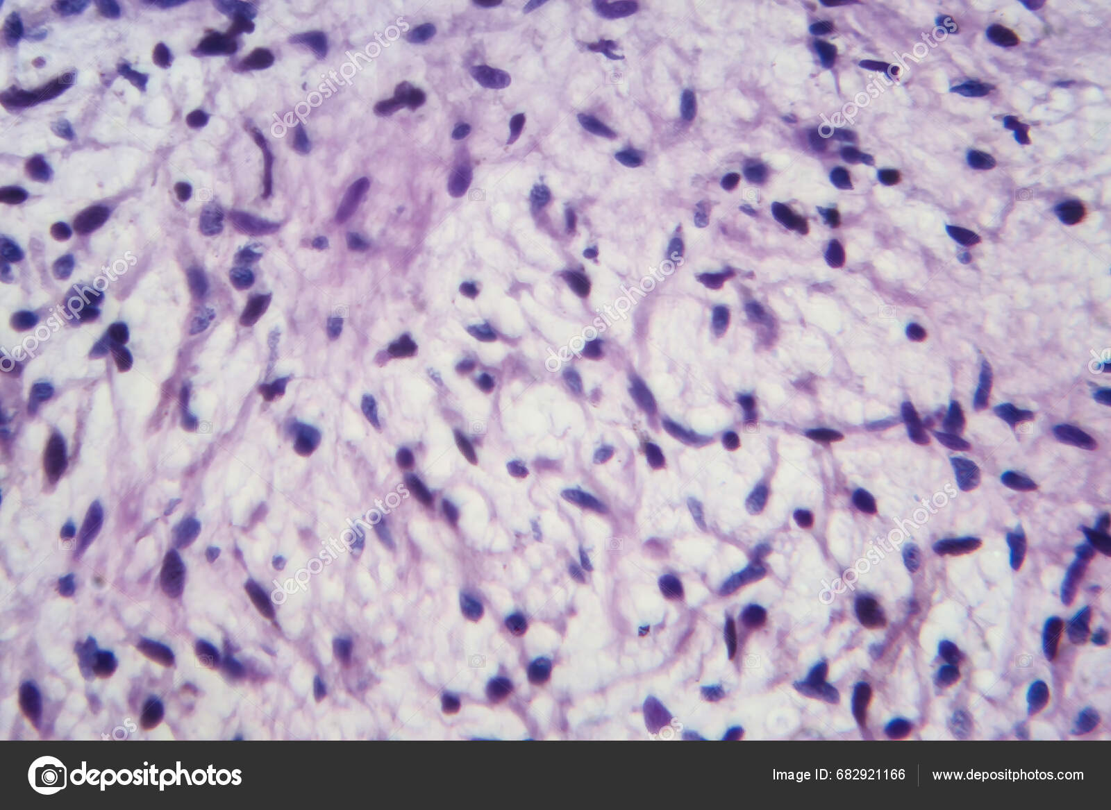 Photomicrograph Neurofibroma Tissue Sample Neurofibromatosis Genetic ...