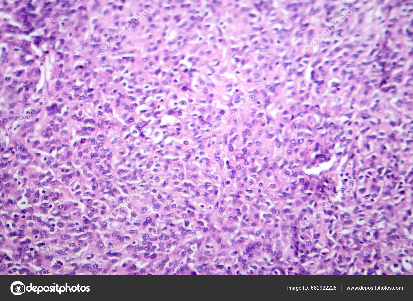 Photomicrograph Astrocytoma Type Brain Tumor Microscope Revealing ...