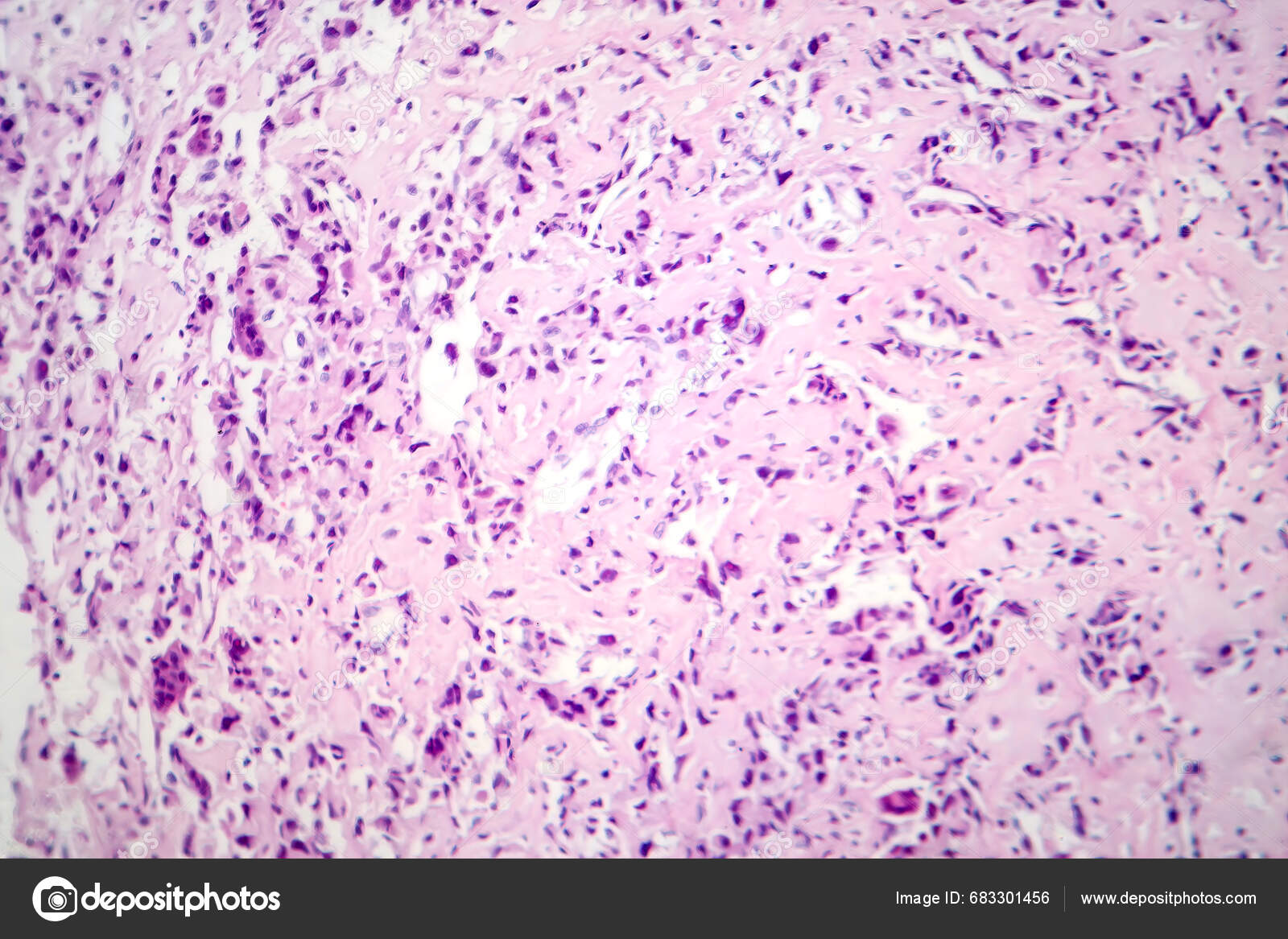 Photomicrograph Osteosarcoma Malignant Bone Tumor Microscope Revealing ...