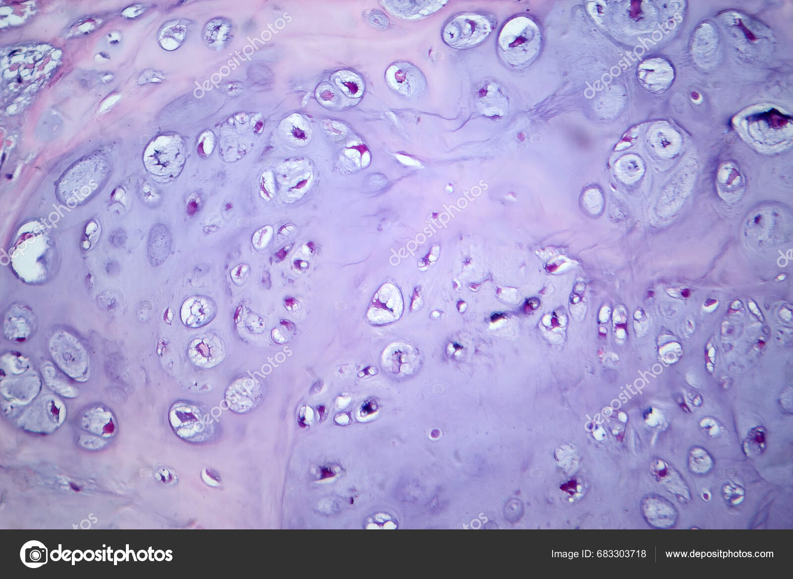 Photomicrograph Chondrosarcoma Malignant Cartilage Tumor Revealing ...