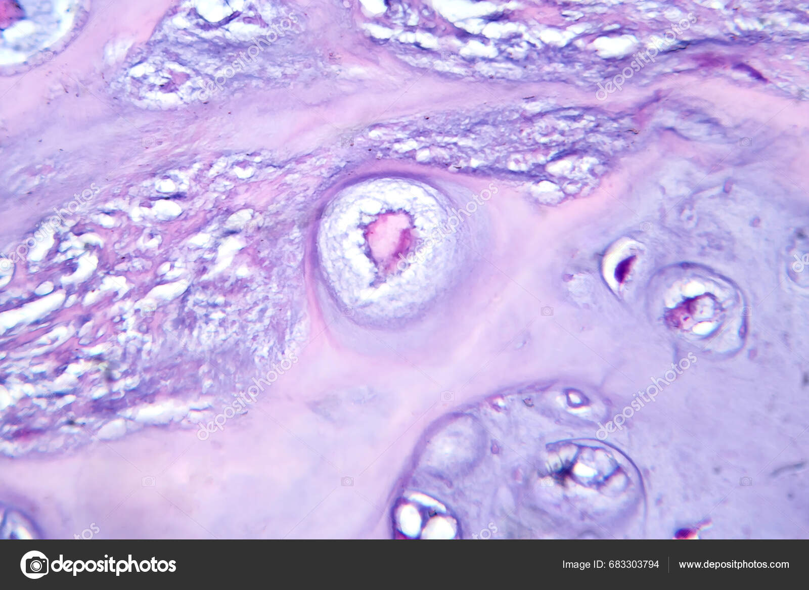 Photomicrograph Chondrosarcoma Malignant Cartilage Tumor Revealing ...