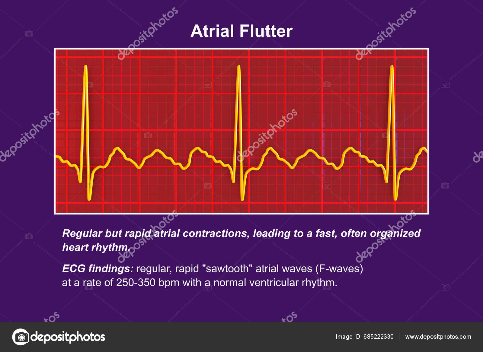 Ecg Aleteo Auricular Ritmo Cardíaco Anormal Caracterizado Por ...