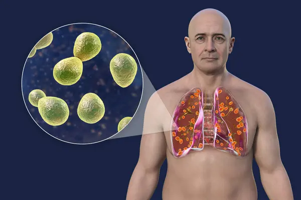 Lungehistoplasmose Soppinfeksjon Forårsaket Histoplasmakapsulatum ...