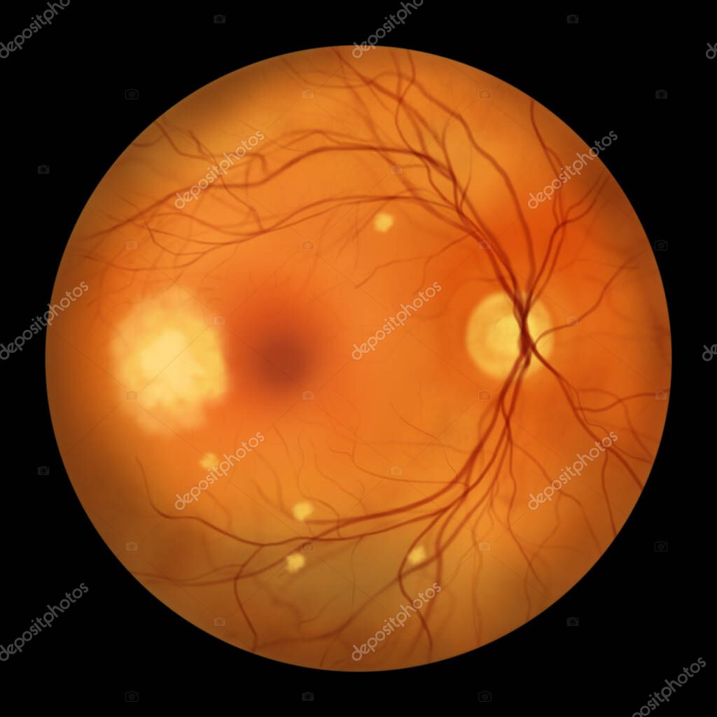 Retina en blastomicosis (infección causada por hongos Blastomyces ...