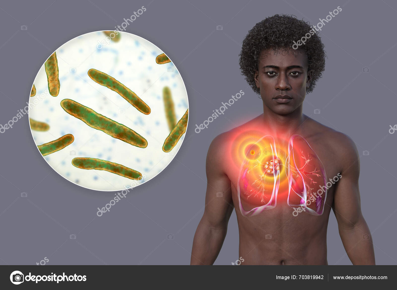Primary Lung Tuberculosis Man Ranke Complex Illustration Showing ...