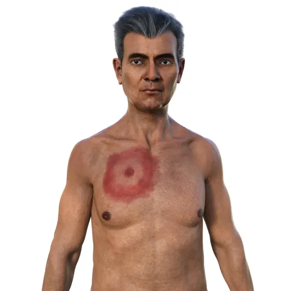 Un hombre con eritema migrans, una erupción característica de la enfermedad de Lyme causada por ...