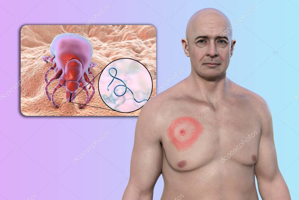 Un hombre con eritema migrans, la erupción característica de la enfermedad de Lyme causada por ...