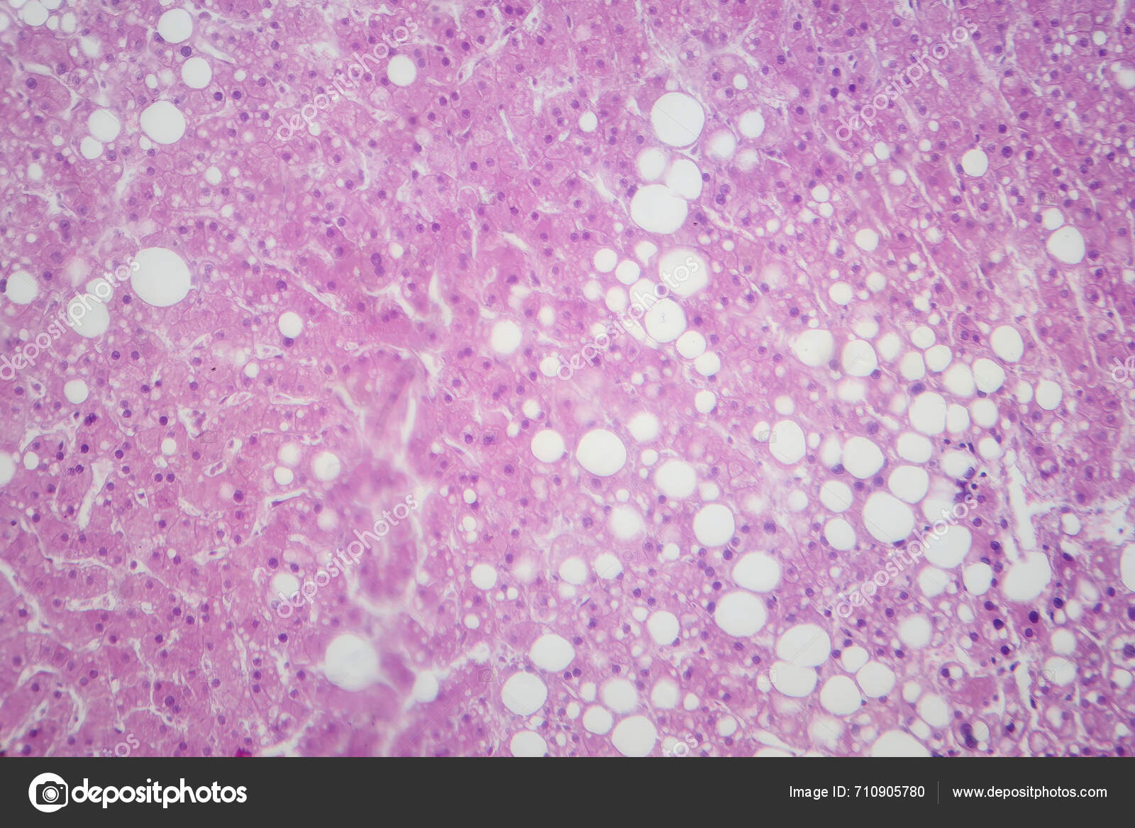 Light Micrograph Revealing Liver Tissue Fatty Infiltration Indicative ...
