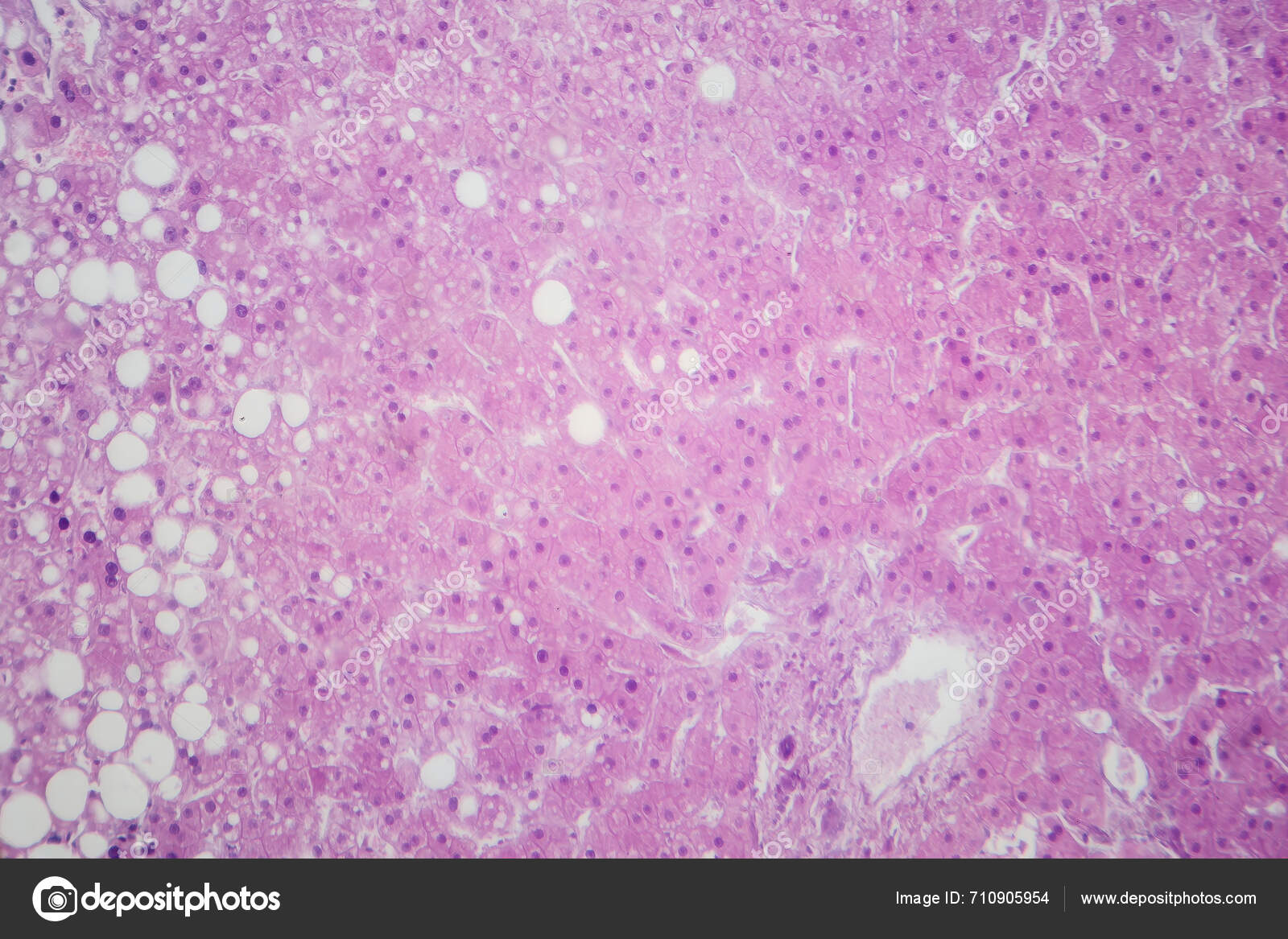 Light Micrograph Revealing Liver Tissue Fatty Infiltration Indicative ...