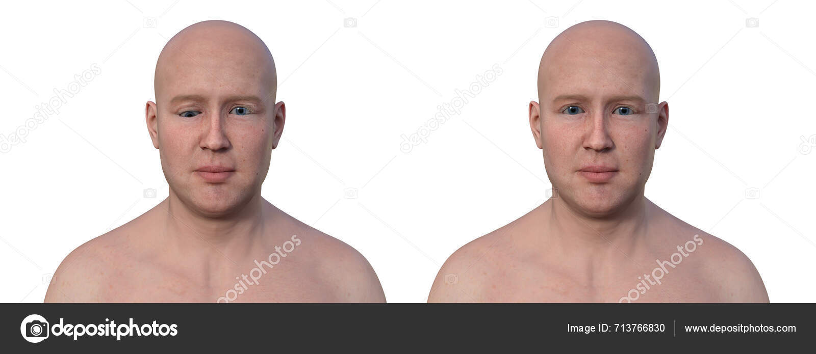 Man Hypotropia Same Healthy Person Illustration Featuring Downward Eye ...