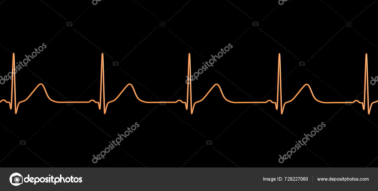 Ilustración Electrocardiograma Ecg Que Muestra Intervalo Prolongado Con ...
