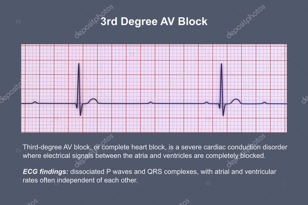Ilustración 3D visualizando un ECG con bloqueo AV de 3er grado, mostrando disociación completa ...
