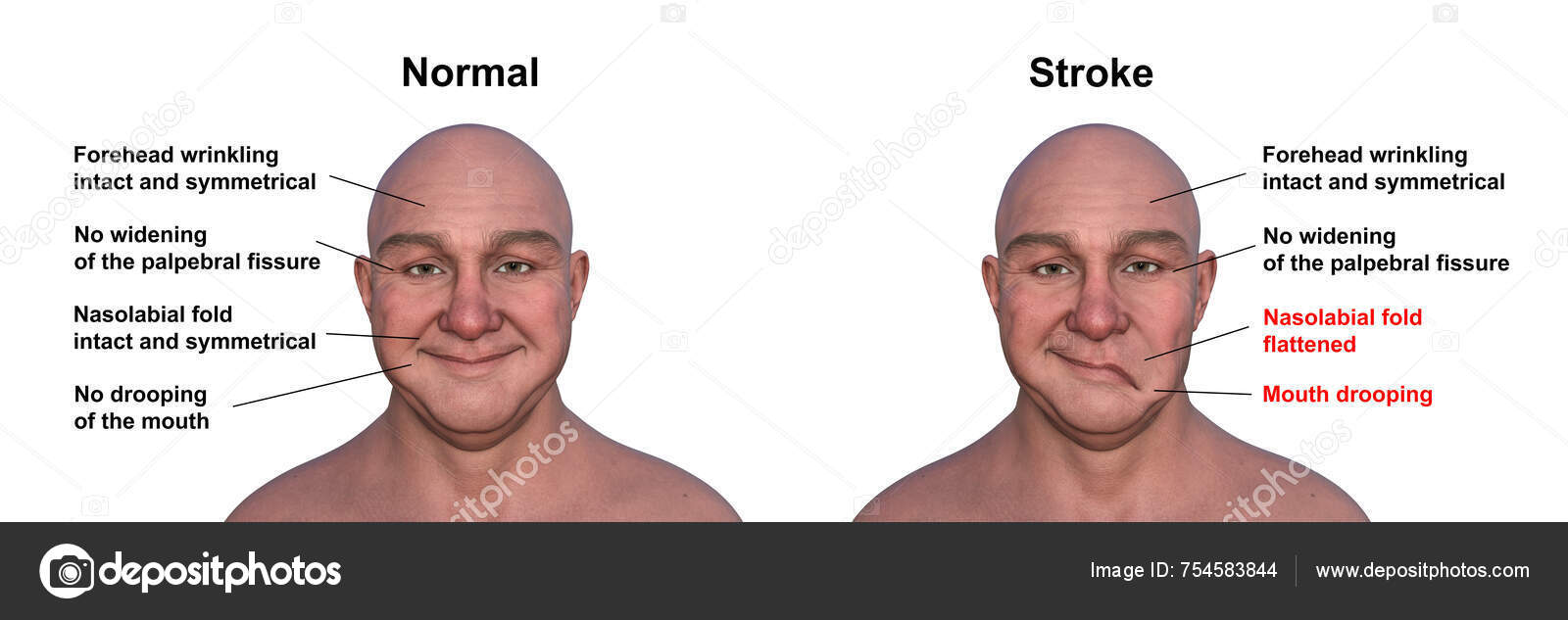 Man Showing Left Side Stroke Drooping Mouth Flat Nasolabial Fold ...