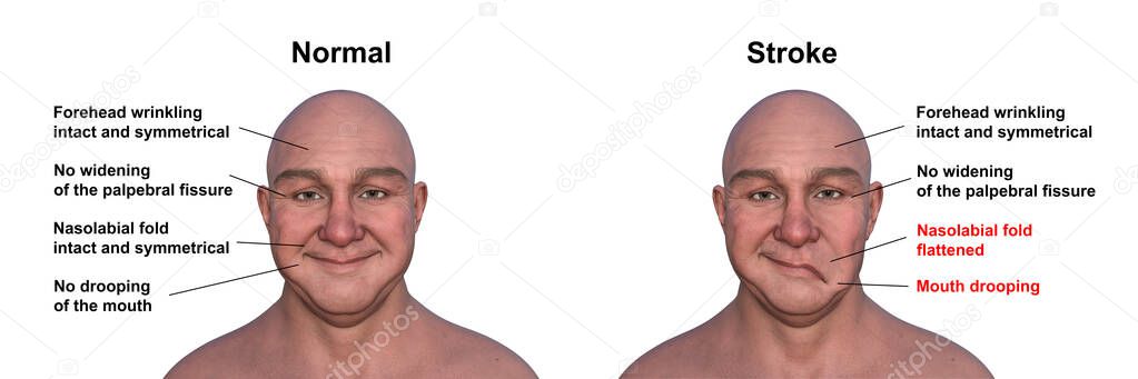 Un hombre que muestra un derrame cerebral en el lado izquierdo, con ...