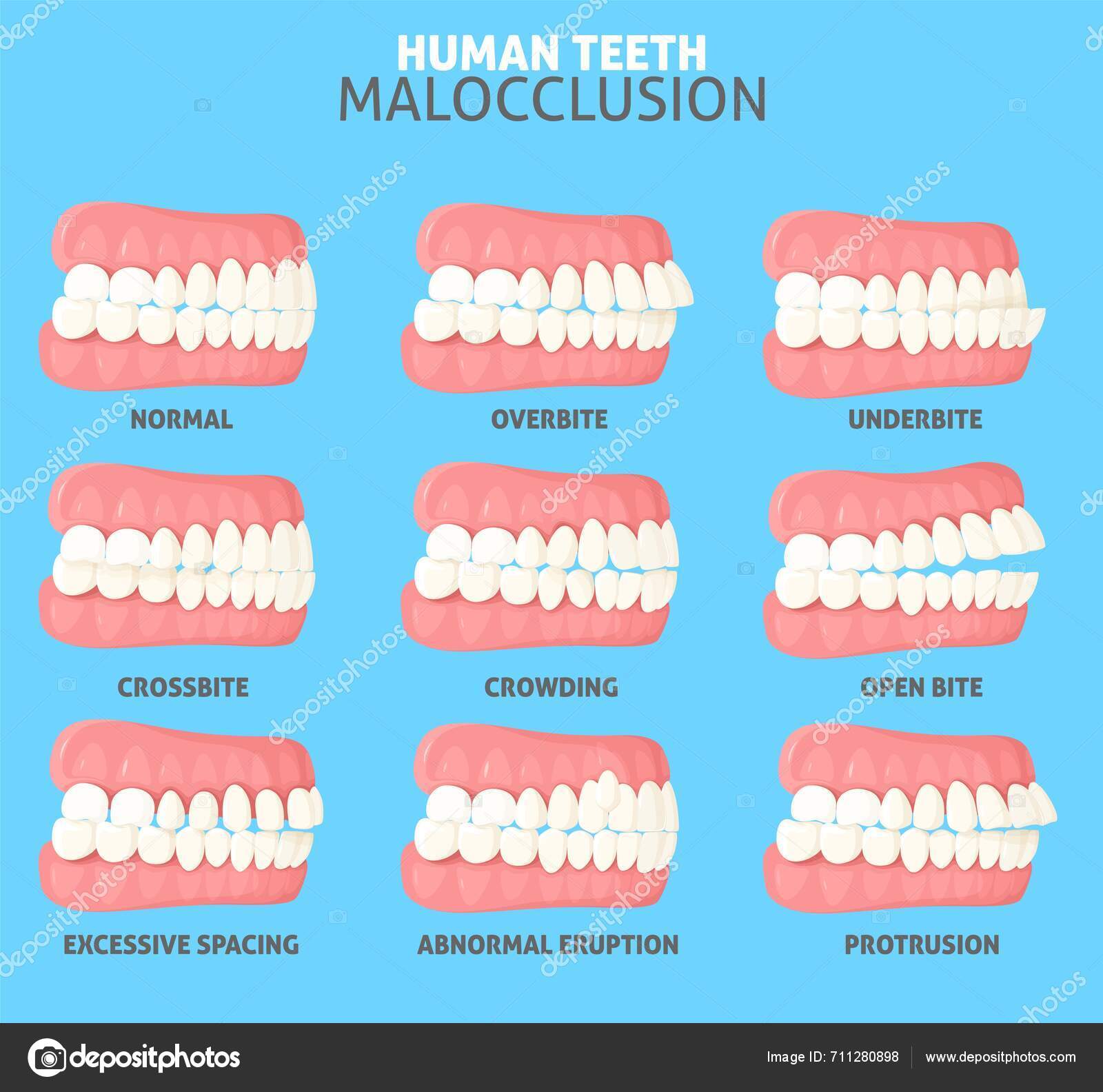 Malocclusion Types Set Side View Normal Misalignment Incorrect Relation ...