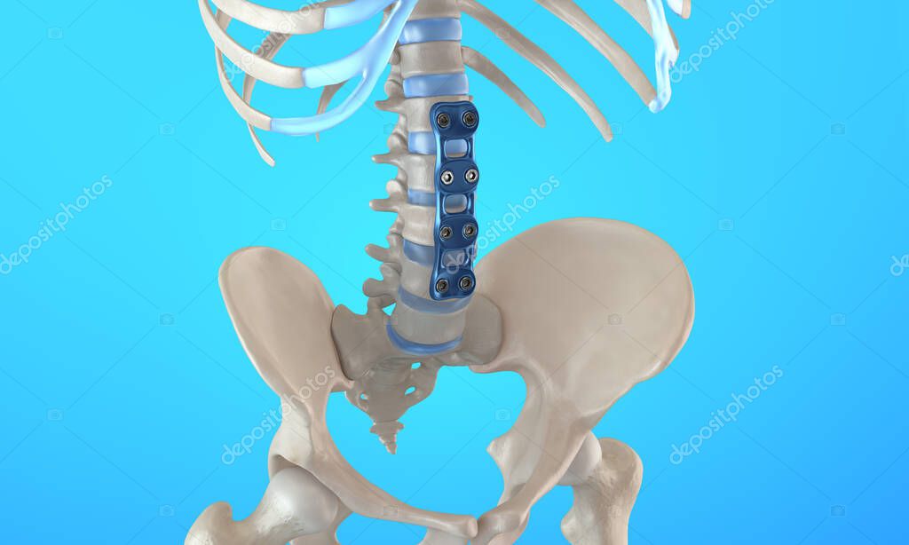 Ilustración médica 3D de la fijación ortopédica de la columna Fijador ...