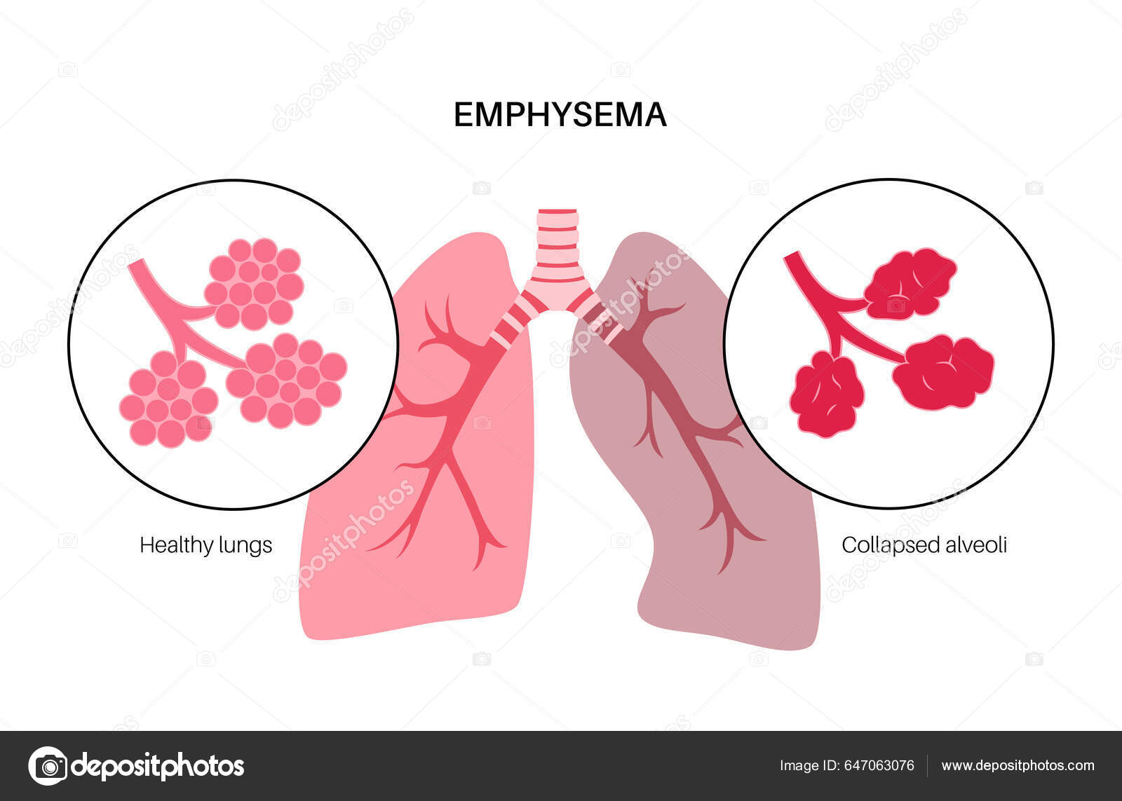 Concepto Enfermedad Por Enfisema Alvéolos Dañados Vías Respiratorias ...